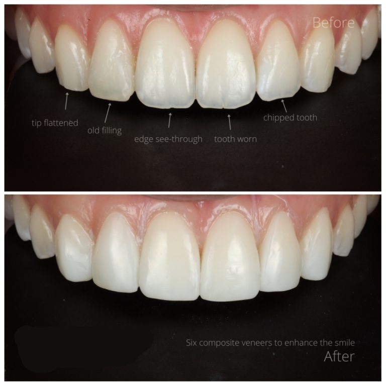 Composite Bonding – Emergency Dental Experts Golders Green